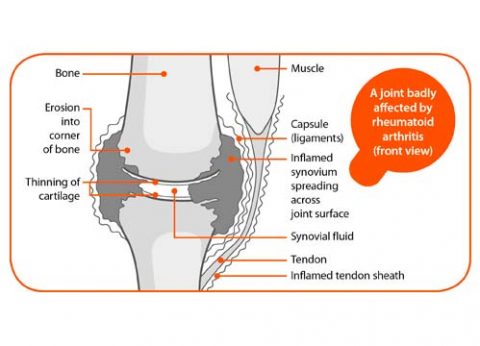Rheumatoid Arthritis - Sports injury clinics in Ipswich, Felixstowe ...