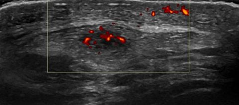 Patella Tendinopathy - Sports injury clinics in Ipswich, Felixstowe ...