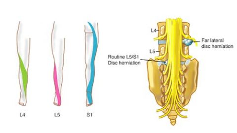 Sciatica - Sports injury clinics in Ipswich, Felixstowe & Leiston