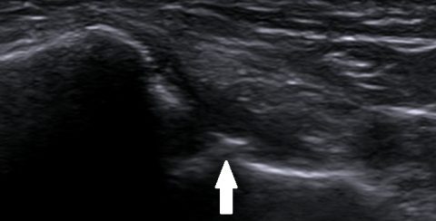 Ultrasound Case Studies - Wrist/Hand - Sports injury clinics in Ipswich ...