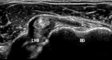 Ultrasound Case Studies - Shoulder - Sports injury clinics in Ipswich ...