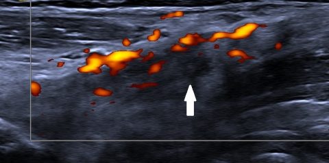 Ultrasound Case Studies - Elbow - Sports injury clinics in Ipswich ...