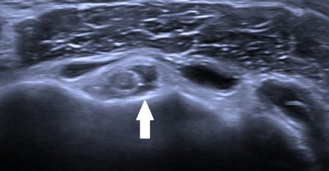 Ultrasound Case Studies - Shoulder - Sports injury clinics in Ipswich ...