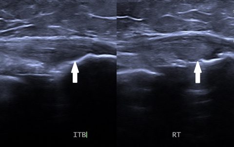 Ultrasound Case Studies - Knee - Sports injury clinics in Ipswich ...