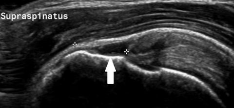 Ultrasound Case Studies - Shoulder - Sports injury clinics in Ipswich ...
