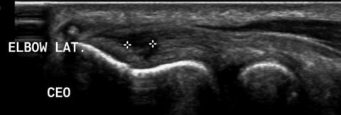 Ultrasound Case Studies - Elbow - Sports injury clinics in Ipswich ...