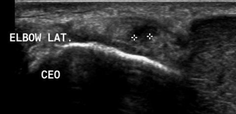 Ultrasound Case Studies - Elbow - Sports injury clinics in Ipswich ...