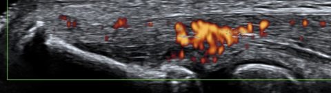 Ultrasound Case Studies - Elbow - Sports injury clinics in Ipswich ...